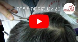 קצה המחט - מרכז לדיקור סיני - מרכז לדיקור סיני - מוקסה על Gv-20 Baihui